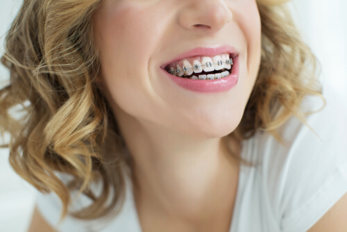 braces with missing teeth - eTransPlus