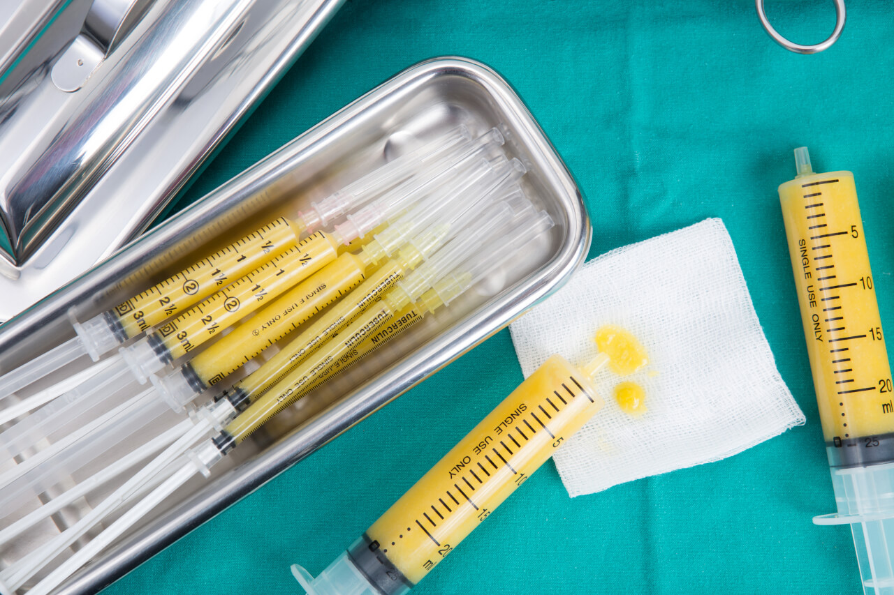 Autologous Fat Transfer: Is it Worth Considering? - eTransPlus